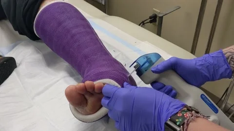 Broken Leg Cast Stock Video Footage | Royalty Free Broken Leg Cast ...