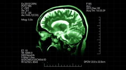 Green side view MRI brain scan display | Stock Video | Pond5