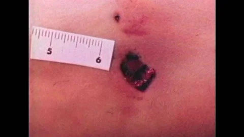 Gunshot wounds are measured and explaine... | Stock Video | Pond5