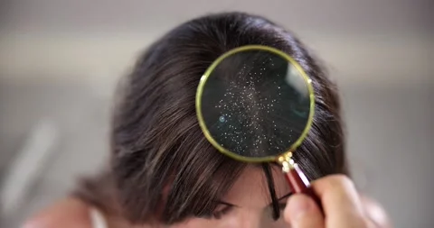 Hair Dandruff And Itchy Scalp Problem | Stock Video | Pond5