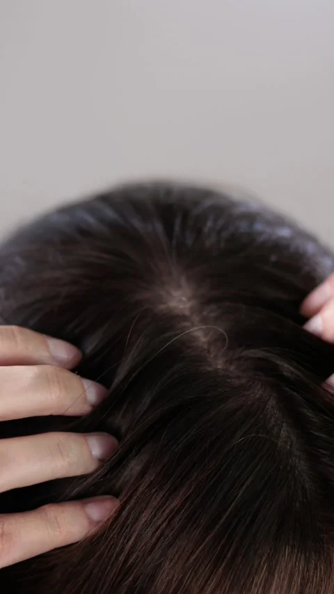 Hair Dandruff And Itchy Scalp Problem | Stock Video | Pond5