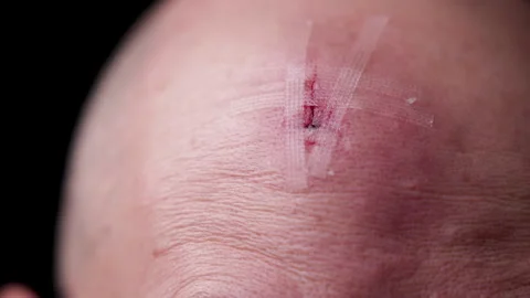 Head injury hematoma and cut. Concussion... | Stock Video | Pond5