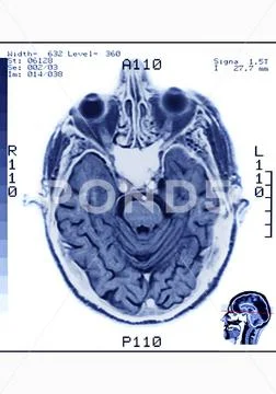 Head, mri Axial section of a human skull visualized by MRI - Are ...