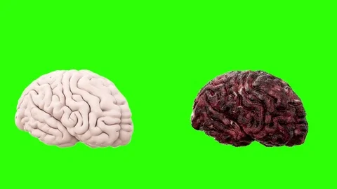 healthy brain and disease brain on green... | Stock Video | Pond5