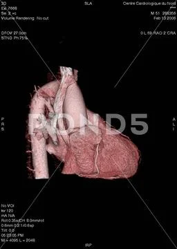 Photograph: Heart, 3d scan Angiography scanner 3D. Superficial view of ...