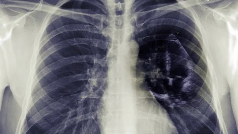 Heart beat and chest x-ray of hospital p... | Stock Video | Pond5