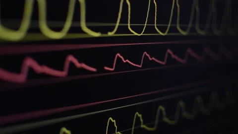 heart monitor screen on the hospital for... | Stock Video | Pond5