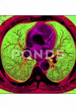 Photograph: Heart, mri Normal human heart. Axial thoracic MRI. The ...
