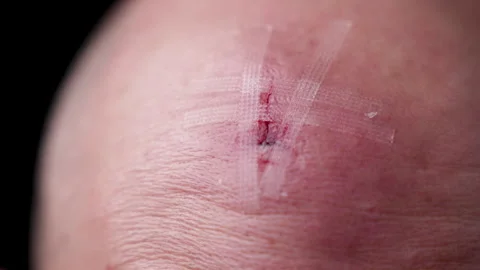 Hematoma contusion and cut on forehead i... | Stock Video | Pond5