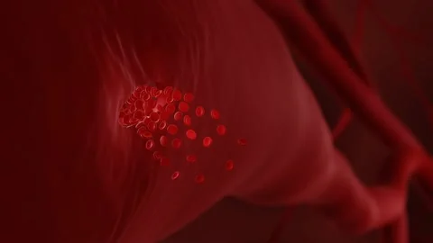 Bleeding Vein Stock Video Footage | Royalty Free Bleeding Vein Videos ...