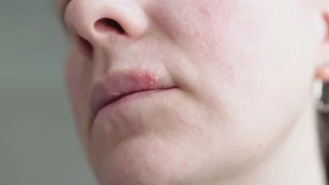 herpes simplex on female upper lip. woma... | Stock Video | Pond5