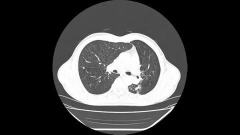 High-Resolution Chest CT Scan (HRCT) of ... | Stock Video | Pond5