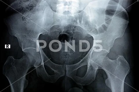 Hip joints digital radiographic examination reveals normal appearance ...