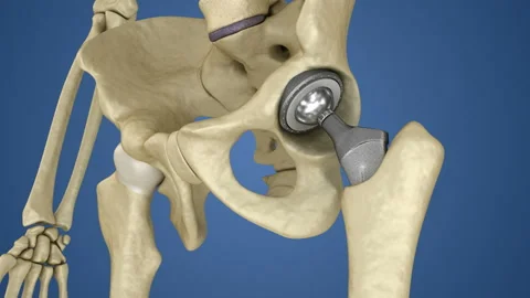 Hip replacement implant installed in the... | Stock Video | Pond5