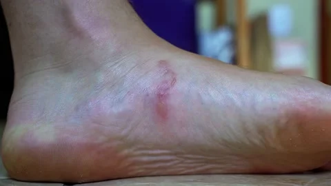 Hookworm infected foot of a young male s... | Stock Video | Pond5