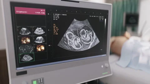 Hospital Pregnancy Scan Monitor Analyzin... | Stock Video | Pond5