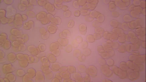 Human Blood. Blood Clots Under Microscop... | Stock Video | Pond5