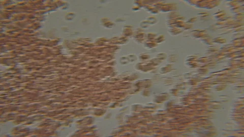 Human Blood, Diseases, Interstitial Flui... | Stock Video | Pond5