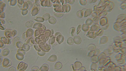 Human Blood, Diseases, Interstitial Flui... | Stock Video | Pond5