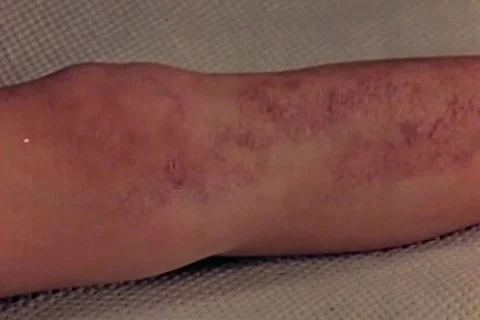 Scar Tissue Stock Footage ~ Royalty Free Stock Videos | Pond5