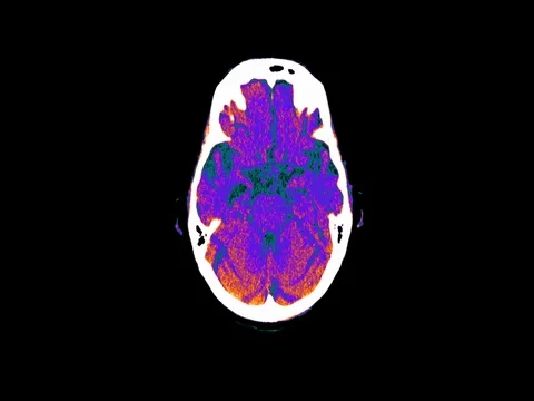 Ct Scan Brain Stock Video Footage | Royalty Free Ct Scan Brain Videos ...