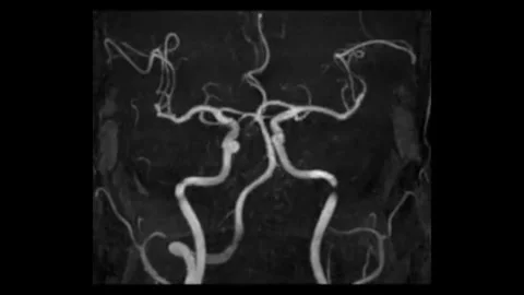 Human Brain Nerves shows with MRI Scan | Stock Video | Pond5