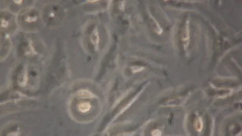 Cancer In T Stock Videos – Royalty-Free HD & 4K Videos