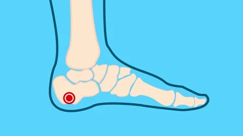 Human foot cartoon. Human foot disease. ... | Stock Video | Pond5