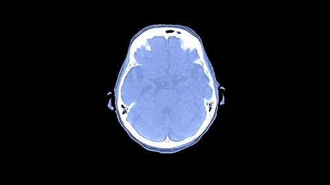 Human Head CT Scan, blue on black backgr... | Stock Video | Pond5