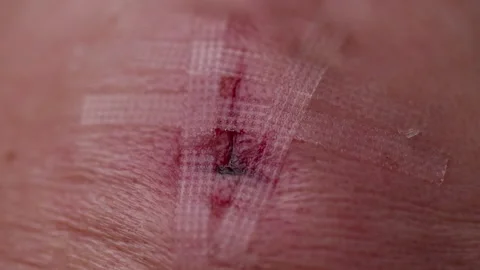 Icing injury head trauma. Skin trauma an... | Stock Video | Pond5