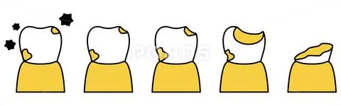 Illustration of image of cavity progression, simple line drawing ...