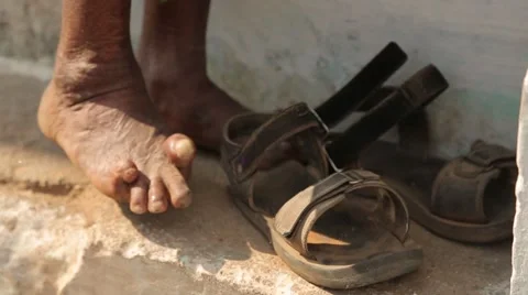 Indian woman with diseased legs | Stock Video | Pond5