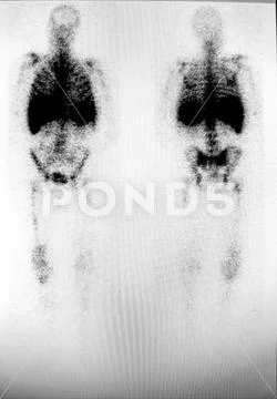 Photograph: Indium labeled WBC scan images - right prosthetic knee ...