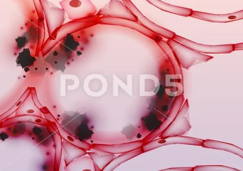 Inflamed Alveoli in Lungs Tissue Slice - Vector Illustration: Graphic ...