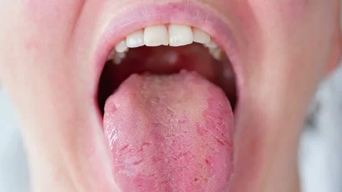 Inflammation of the oral cavity, yellow ... | Stock Video | Pond5
