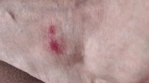 Skin Inflammation Stock Videos – Royalty-Free HD & 4K Videos