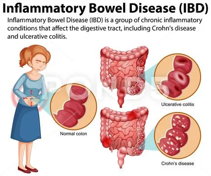 Inflammatory Bowel Disease (IBD) Infographic: Graphic #235268849