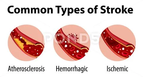 Infographic of common types of stroke: Royalty Free #196962266