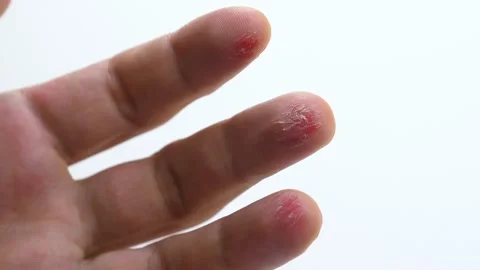 Injured fingers of man hand. Scratched s... | Stock Video | Pond5