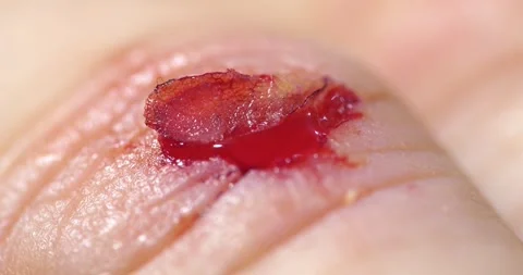 Injury to middle finger of right hand wi... | Stock Video | Pond5