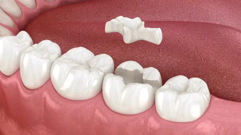 Inlay ceramic crown placement. Medically... | Stock Video | Pond5