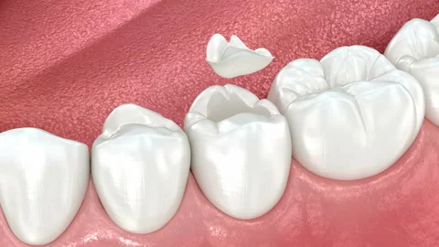 Inlay ceramic crown placement. Medically... | Stock Video | Pond5