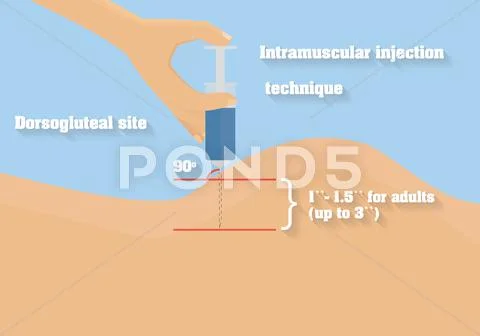 Intramuscular injection technique vector illustration. Illustration ...
