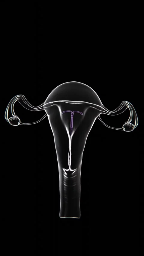 Intrauterine Device (IUD) in Female Repr... | Stock Video | Pond5