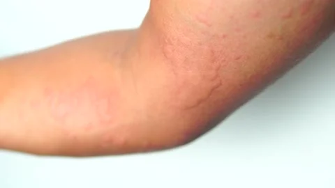 Itchy, allergic reaction, Close up rash ... | Stock Video | Pond5