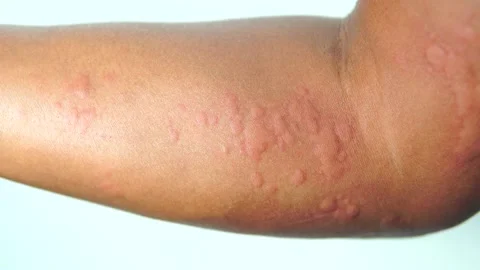 Itchy, allergic reaction, Close up rash ... | Stock Video | Pond5