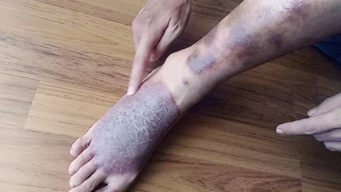 itchy allergy hives rash eczema atopic ... | Stock Video | Pond5