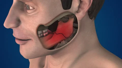 A jaw bone side view Fracture | Stock Video | Pond5