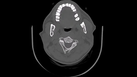 Jefferson fracture, CT scan | Stock Video | Pond5