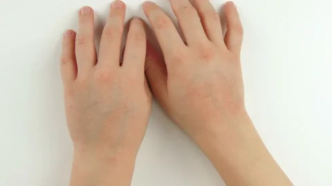 Kid hands close-up. Allergies, dermatiti... | Stock Video | Pond5